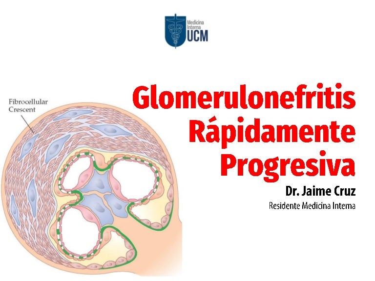 Glomerulonefritis Rápidamente Progresiva