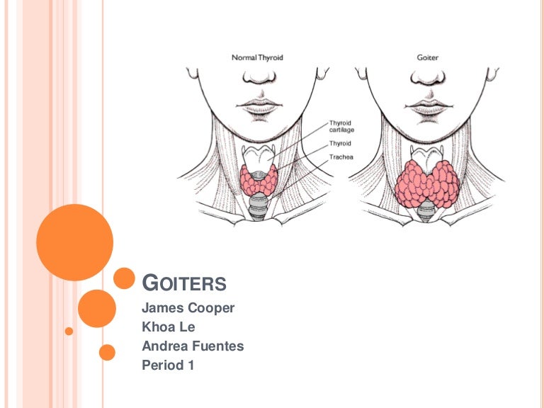 Goiters 120223070355-phpapp01[1]