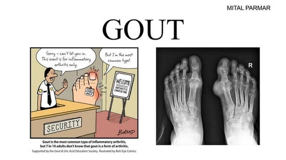 Pathophysiology of Gout | PPT