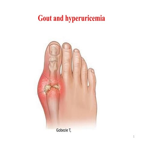 Gout and hyperuricemia--usiu.pdf