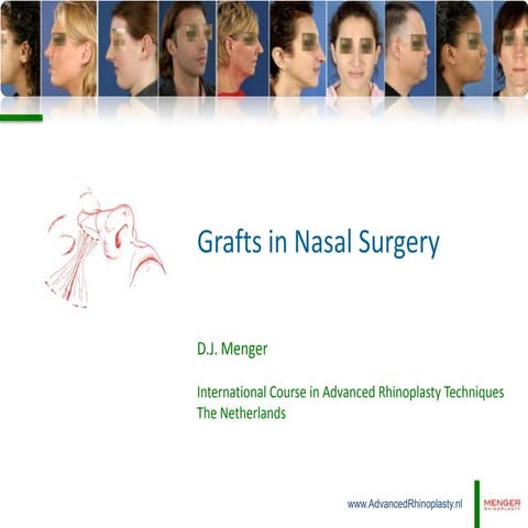 Grafts in Nasal Surgery - Advanced Rhinoplasty | PPTX