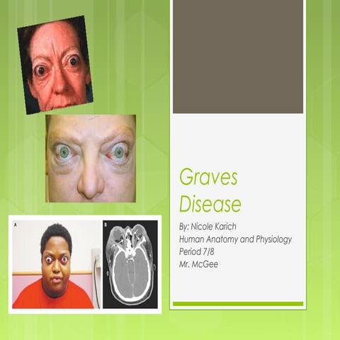Autoimmune Diseases "Graves' Disease" | PPTX
