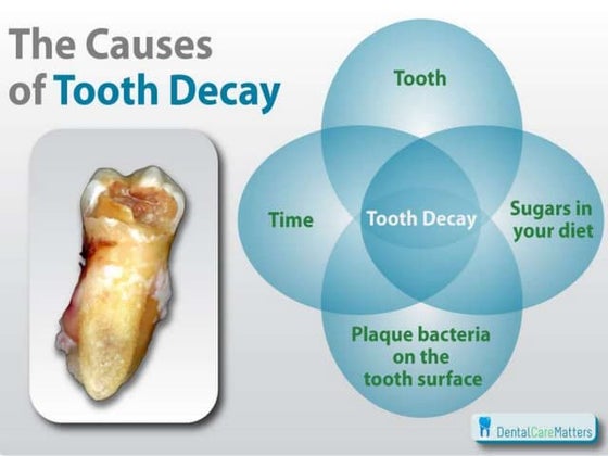 Dental decay and ways to prevent it | PPT