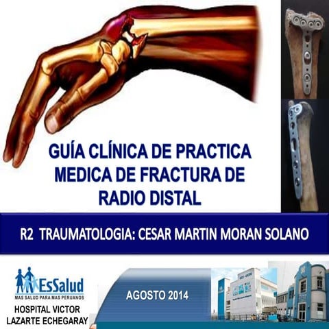 ESSALUD - GUIA CLINICA DE PRACTICA MEDICA DE RADIO DISTAL EN ADULTOS | PPTX