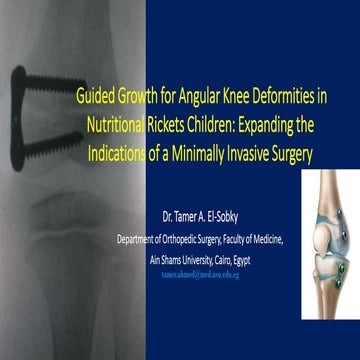 Guided Growth for Angular Knee Deformities in Nutritional Rickets ...