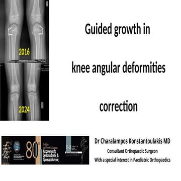 Guided growth in knee angular deformities final.pptx