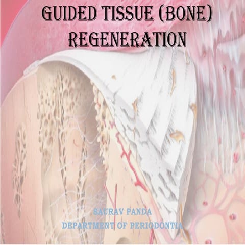 GUIDED TISSUE (BONE) REGENERATION PERIO.pptx