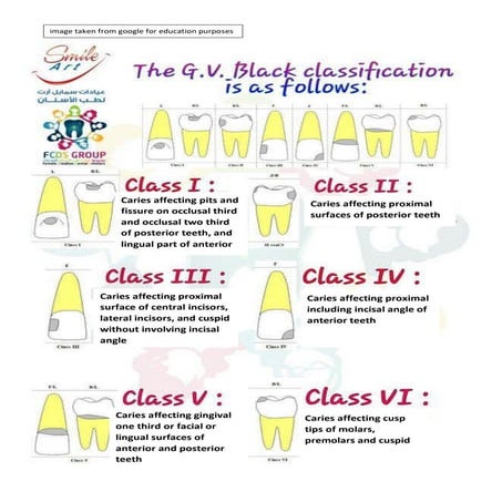 Gv black classification of caries | PDF