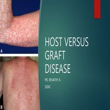 Graft versus host disease | PPTX