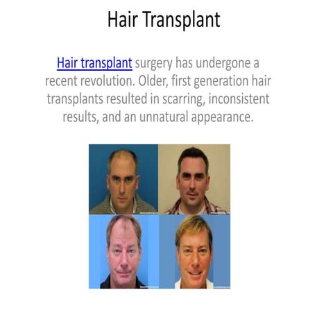 Hair transplant | PPTX