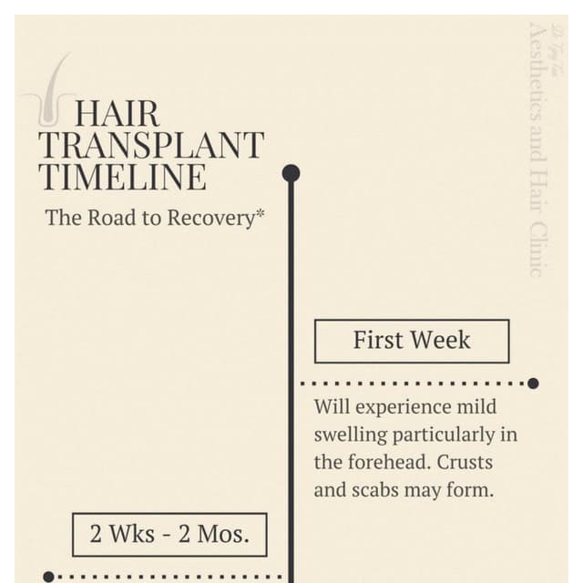 Hair Transplant Timeline [Infographics]: The Road to Recovery | PDF