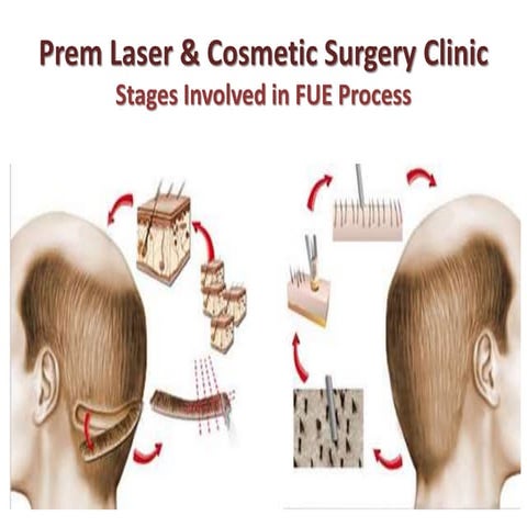 Stages of FUE Process | PPTX