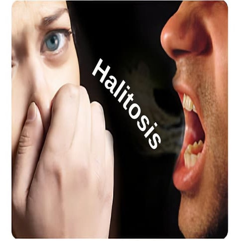 Oral Halitosis (Bad Breath) and its management.pptx