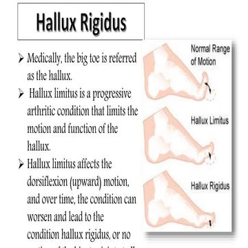 Hallux rigidus | PPTX