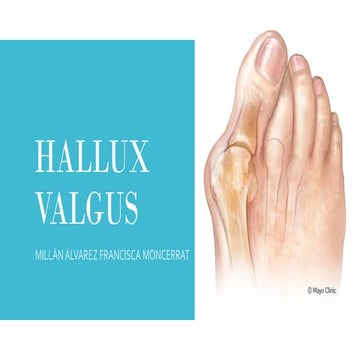 HALLUX VALGUS TRATAMIENTO FISIOTERAPEUTICO.pdf