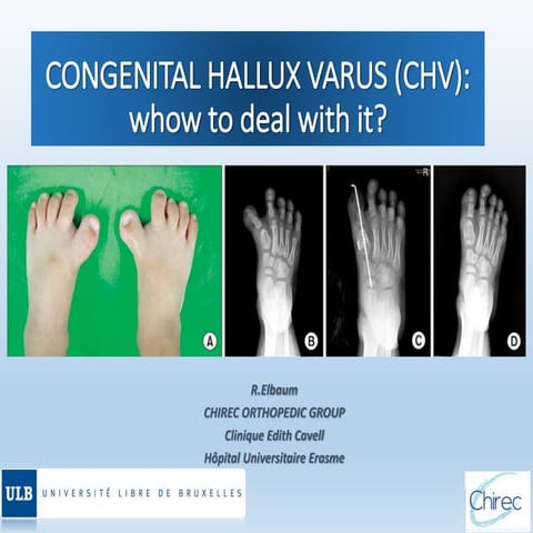 Congenital Hallux varus: How to deal with it? | PPTX