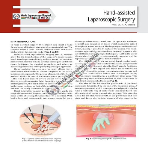 Laparoscopic Splenectomy at World Laparoscopy Hospital | PDF