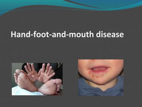 Hand foot-mouth disease (hfmd) | PDF | Infectious Diseases | Diseases ...