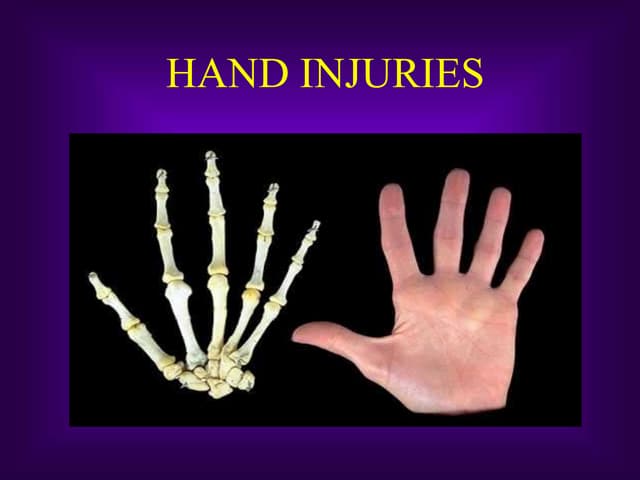 metacarpals & phalanges fractures.pptx