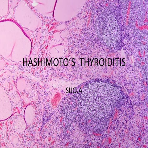 hashimotosthyroiditis-170825171347.pdf