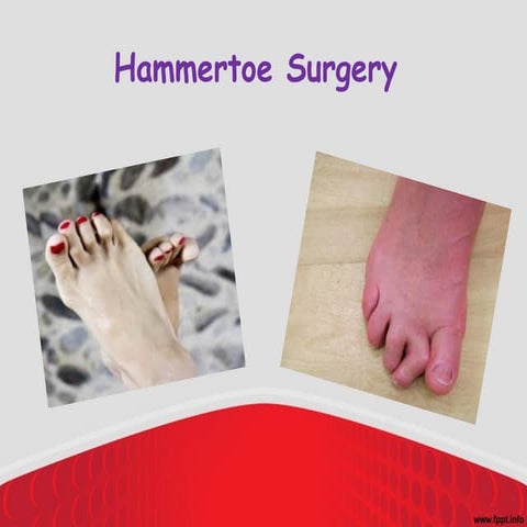 Hammer toe
