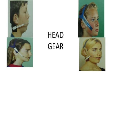 Head gear in orthodontics | PPTX