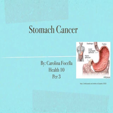 Health 10 Ppt[1]. Stomach Cancer | KEY