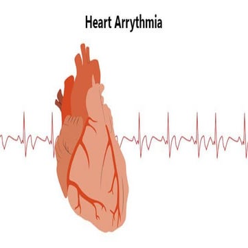 Arrhythmia | PDF