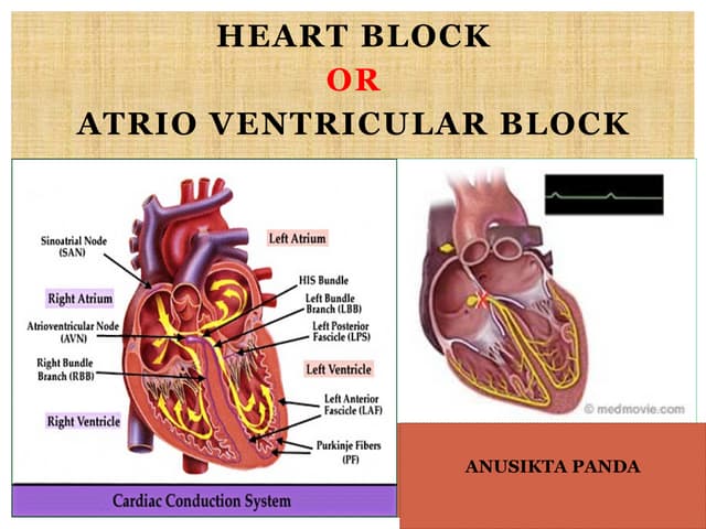 Ventricular Tachycardia and Ventricular Fibrillation Presentation | PPTX