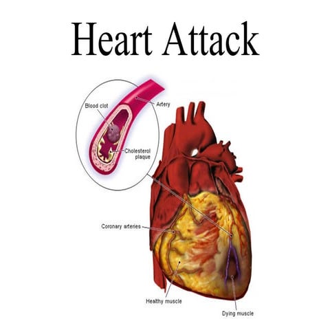 Heart attack plaque blood pressure | PPT