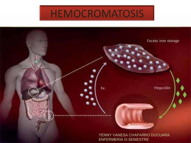 Hemocromatosis hereditaria
