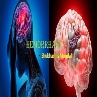 INTRA CRANIAL HEMORRHAGE- AGING BLOOD ON MRI | PPTX