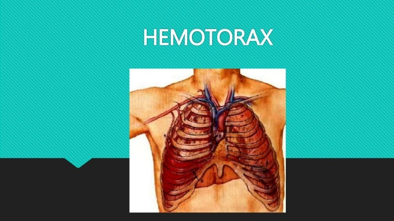Hemotorax y neumotorax