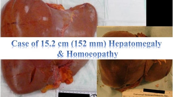 Fatty Liver, Bowel Inflammation & Inflammatory Bowel Disease within 1 ...