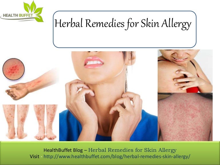 Herbal Remedies For Skin Allergy