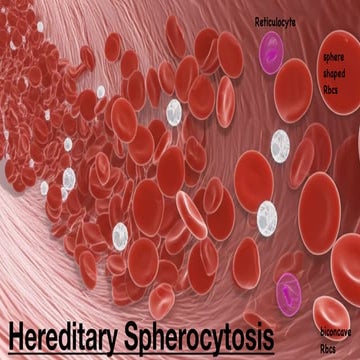 Hereditary Spherocytosis .pdf | Anemia | | PDF
