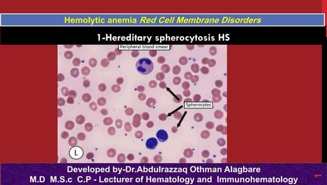 Paroxysmal Nocturnal Hemoglobinuria Blood Smear