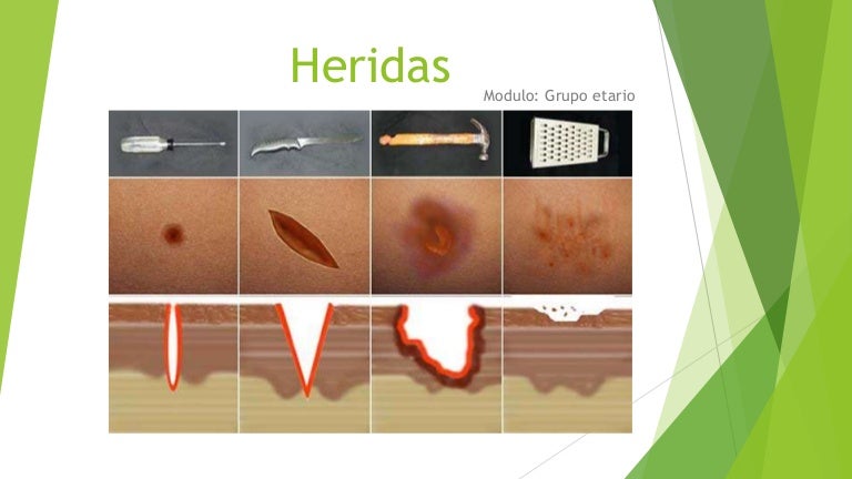 Heridas