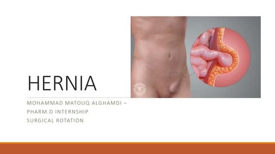 Hernia | PPT | Digestive Disorders | Diseases and Conditions