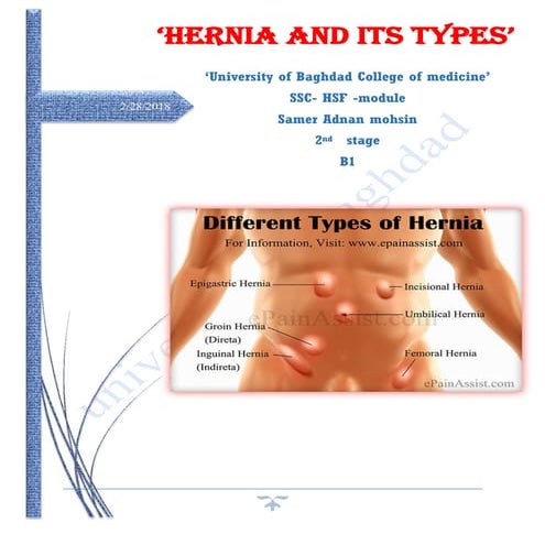 Hernia Inguinal Indireta Vs Direta