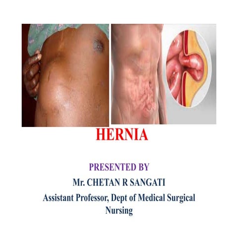 hernia.pptx
