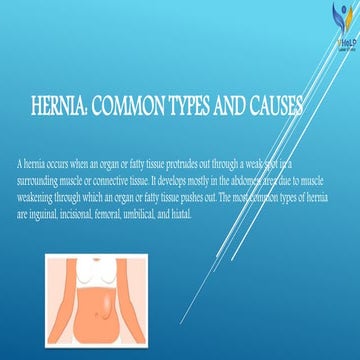 Hernia: common types and causes | PPTX