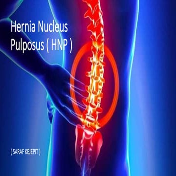 Hernia Nucleus Pulposus ( HNP ).pptx