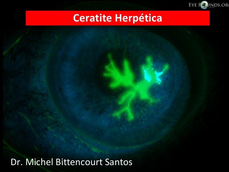 Ceratite Herpética