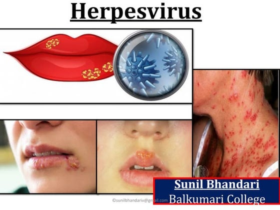 Herpes simplex virus | PPTX
