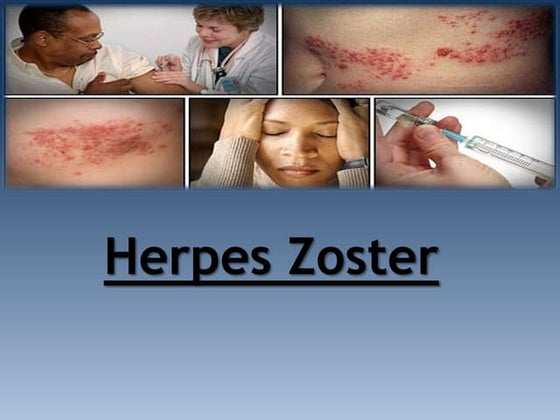 Herpes simplex virus | PPT