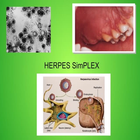 Herpes Simplex RC | ODP | Infectious Diseases | Diseases and Conditions
