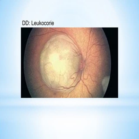 Leukocorie | PDF | Eye and Vision Conditions | Diseases and Conditions