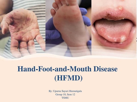 Hand foot-mouth disease (hfmd) | PDF | Infectious Diseases | Diseases and Conditions