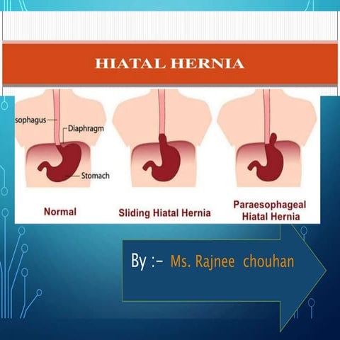 hiatal-hernia.pptx